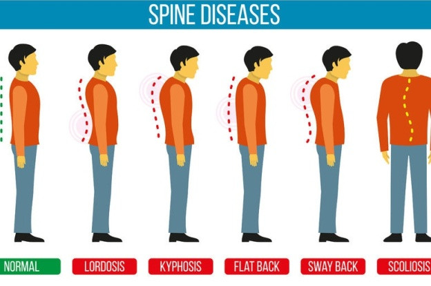 CLASSIC SIGNS OF SPINAL MALALIGNMENT :: Chiropractor Tomball